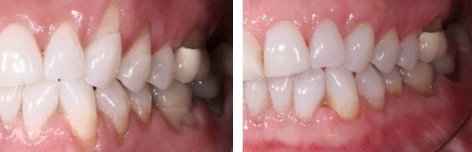 Gum Lift Treatment Knoxville Tn Pinhole Gum Surgery
